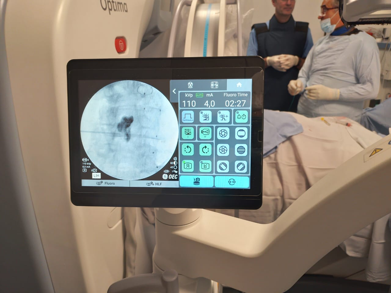 Embolización De Endoleak Tipo Ii Por Punción Translumbar Guiada Por