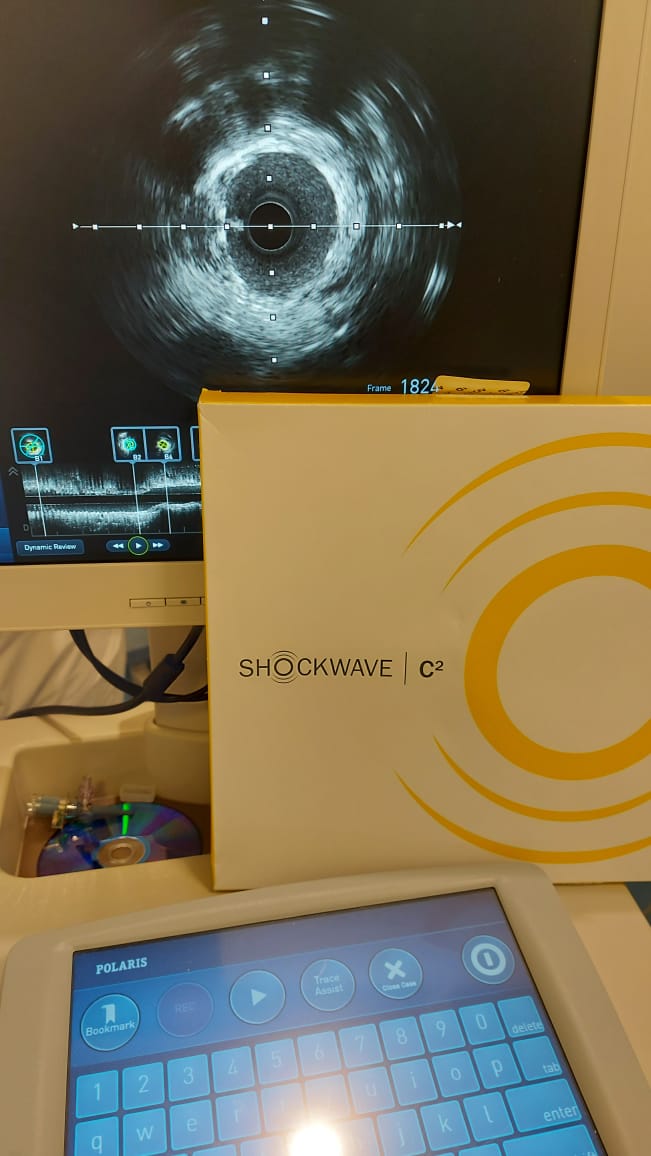 Angioplastia coronaria a lesión severamente calcificada de arteria ...