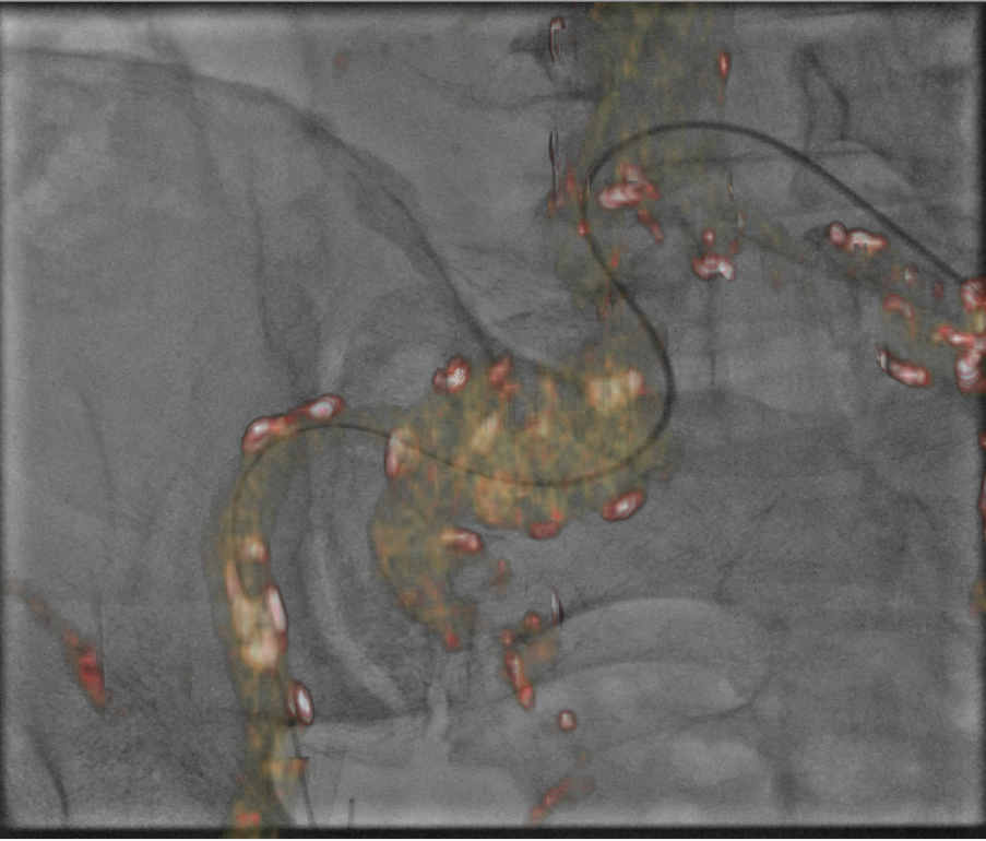 Tratamiento endovascular de aneurisma ilíaco aislado con prótesis ...