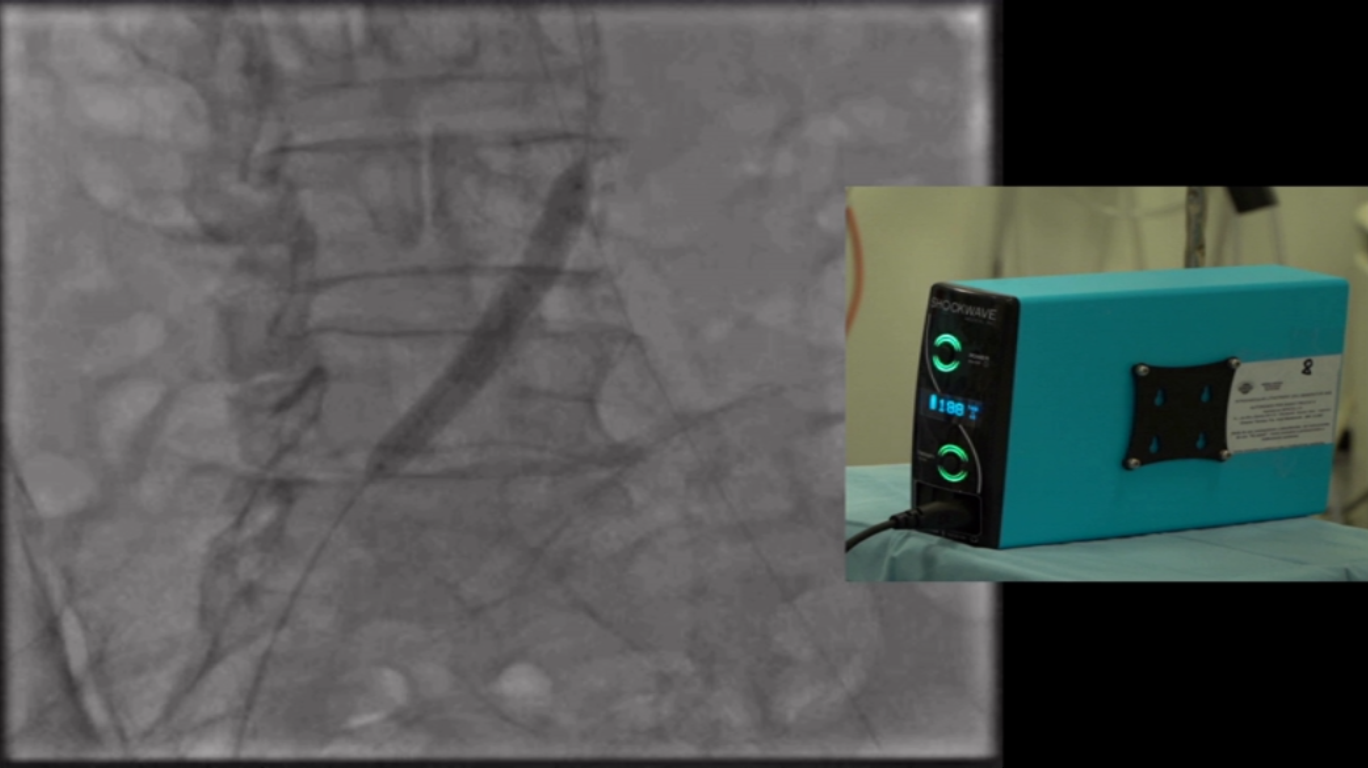 Litotricia intravascular para el tratamiento de lesión severamente ...