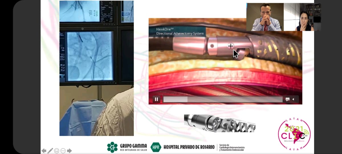 Angioplastia periférica con Aterectomía Direccional HawkOne - SCITE