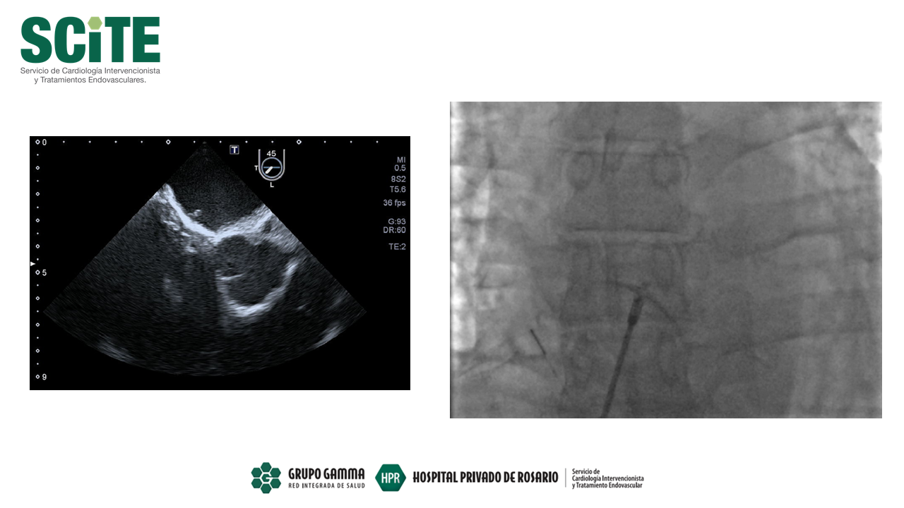 Cierre endovascular de foramen oval permeable (FOP) - SCITE