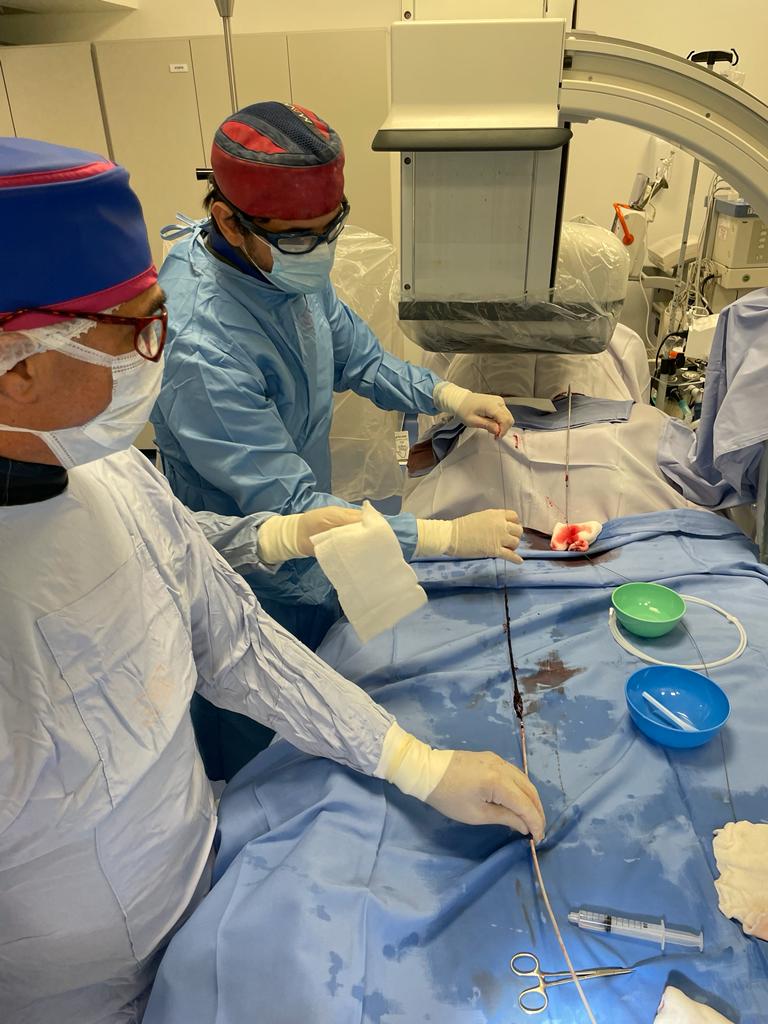 Tratamiento endovascular de TVP extensa con sistema ClotTriever - SCITE